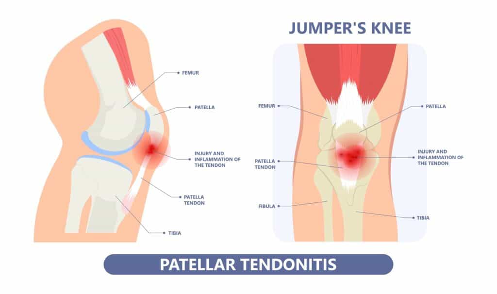 Patellar Tendinitis Explained: From Overuse to Healing • Toledo, OH ...